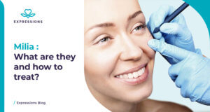 Milia Seeds: What Are They And How To Treat? | Expressions